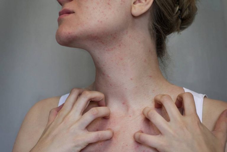 Svrab se šíří Českou republikou. Není to jen kvůli zanedbané hygieně ...